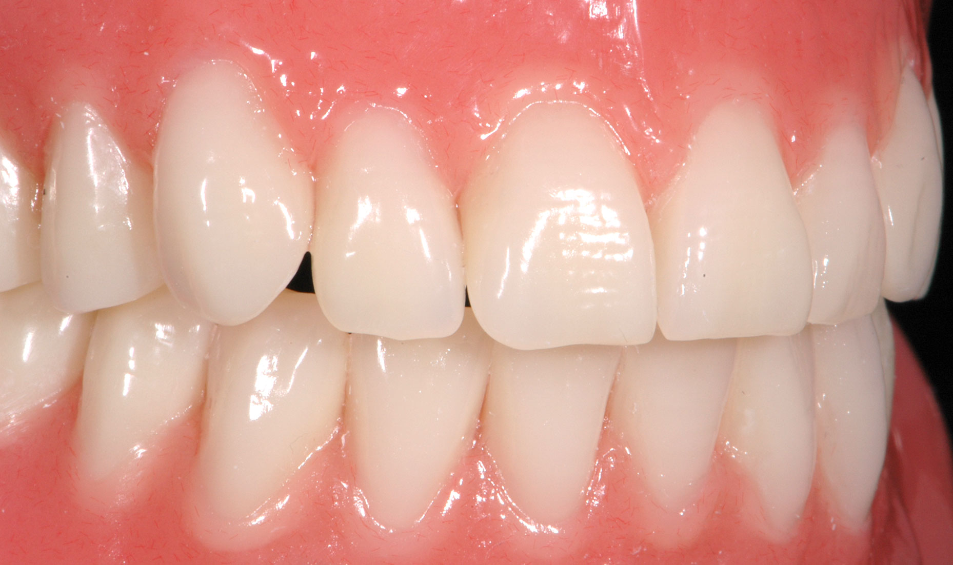 TiF® -System-Totalprothetik: Anforderungen – Argumentation – Anleitung ...